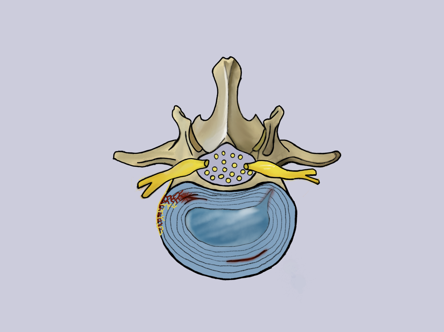 What is a slipped disc - Crestacre Chiropractic Clinic